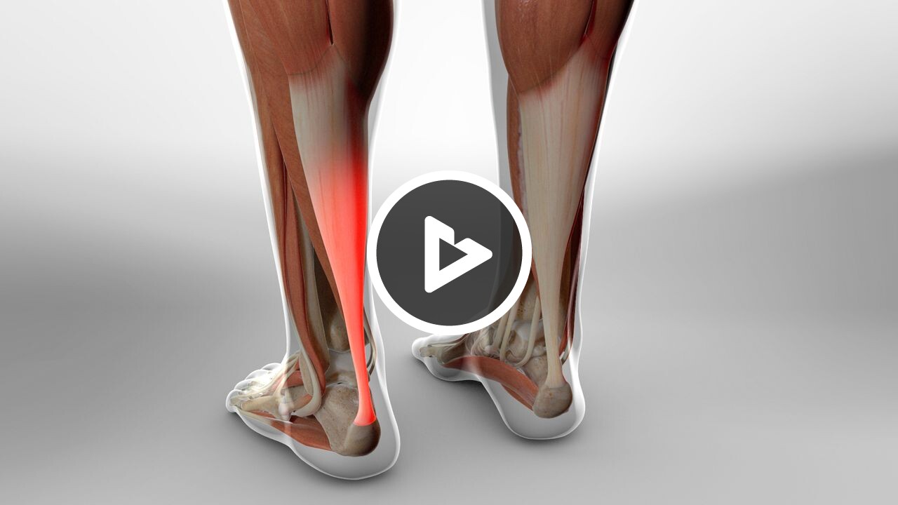 Achilles Tendon Lengthening (Percutaneous Method)