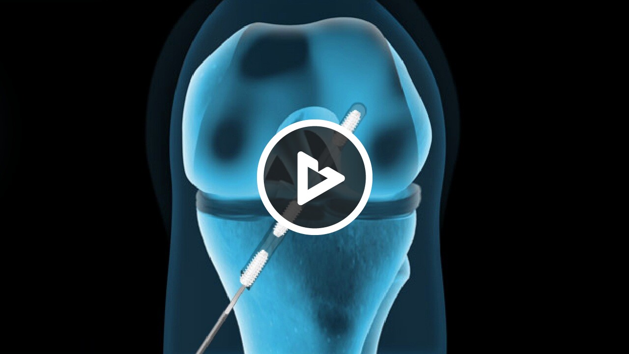 ACL Reconstruction (Arthrex RetroScrew)
