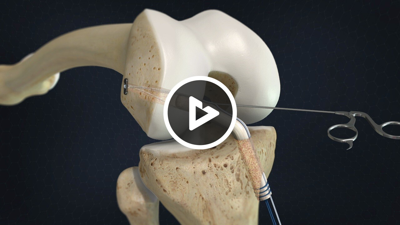 ACL Reconstruction (Arthrex® TightRope®)