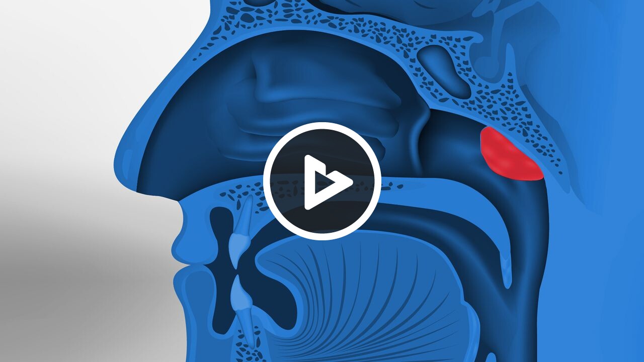 Adenoiditis