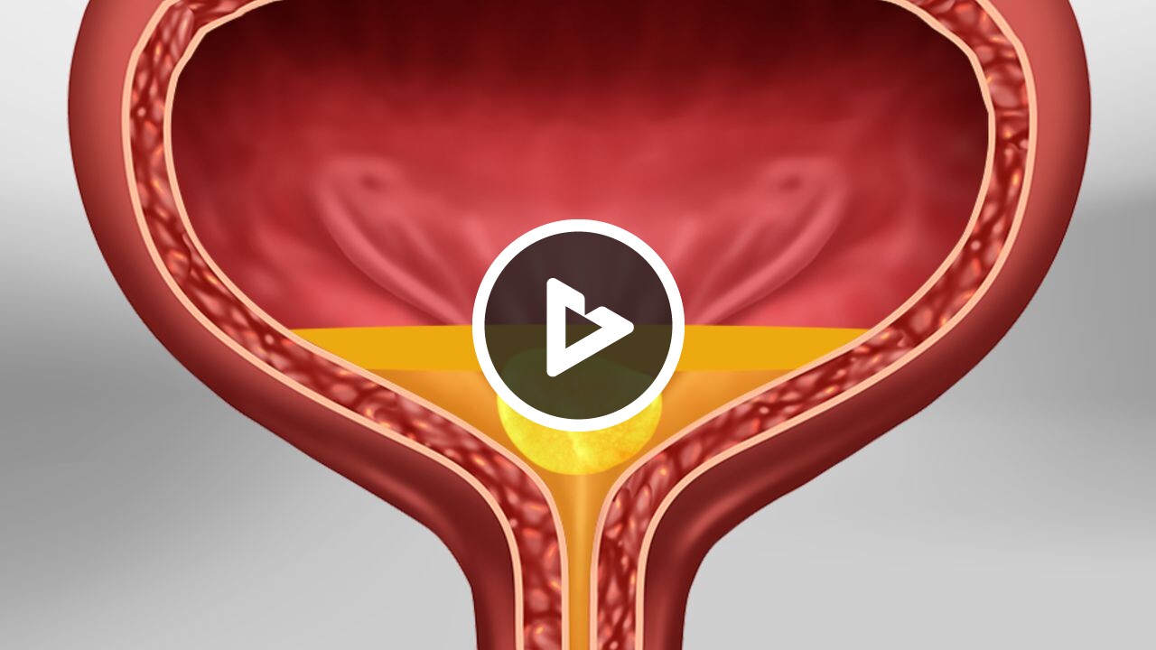 Bladder Stones