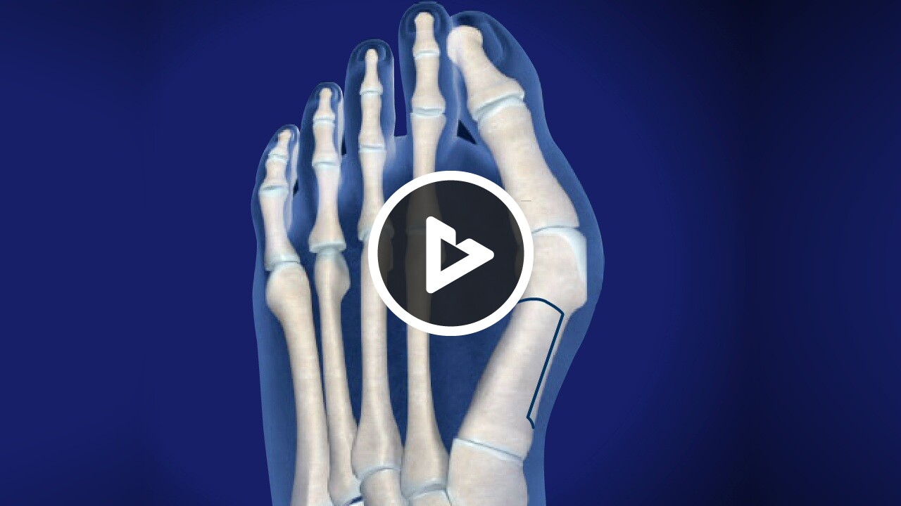 Bunion Correction with Scarf and Akin Osteotomy