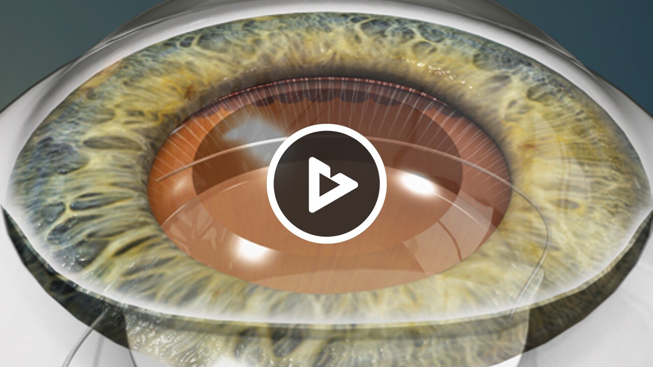 Cataract Removal (Extracapsular Cataract Extraction Method)