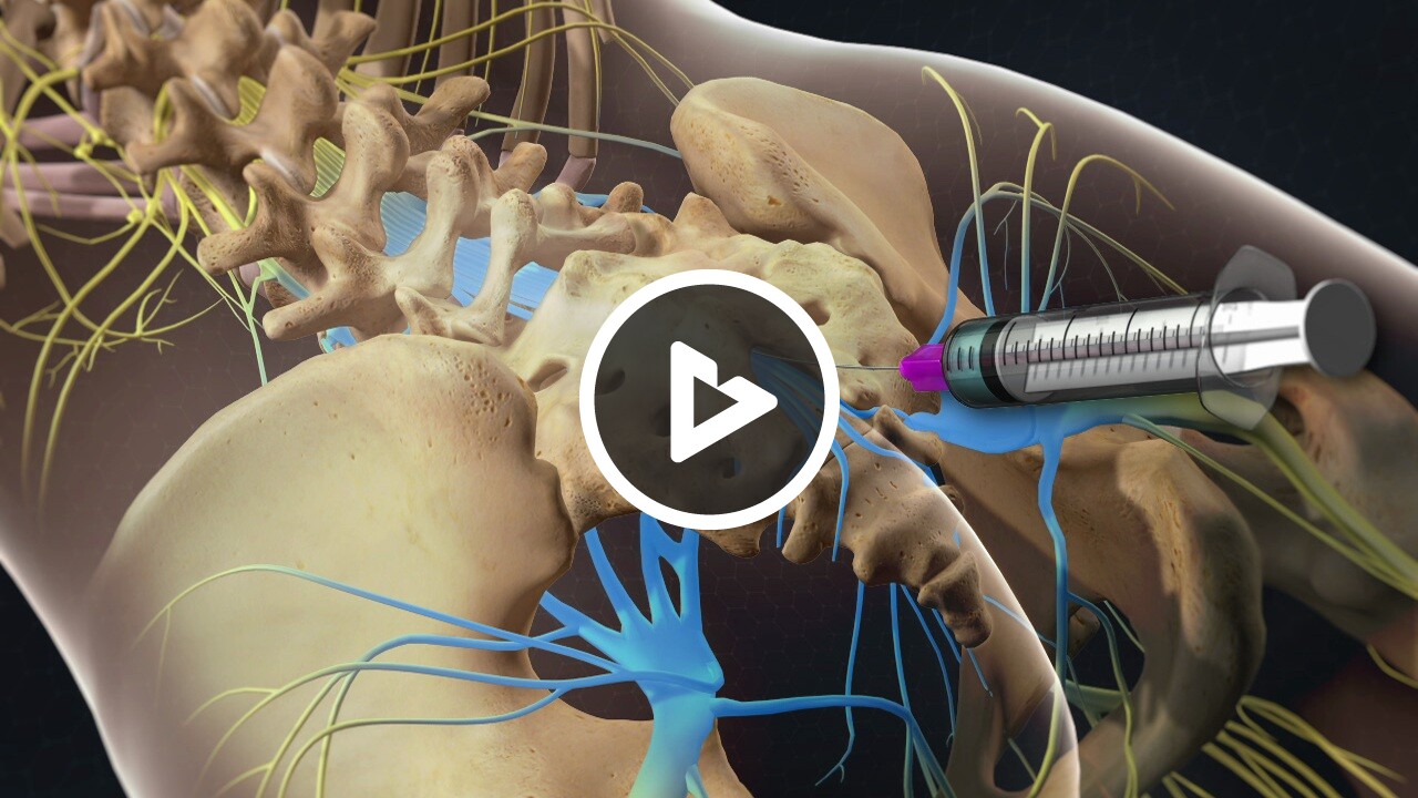 Caudal Epidural Steroid Injection