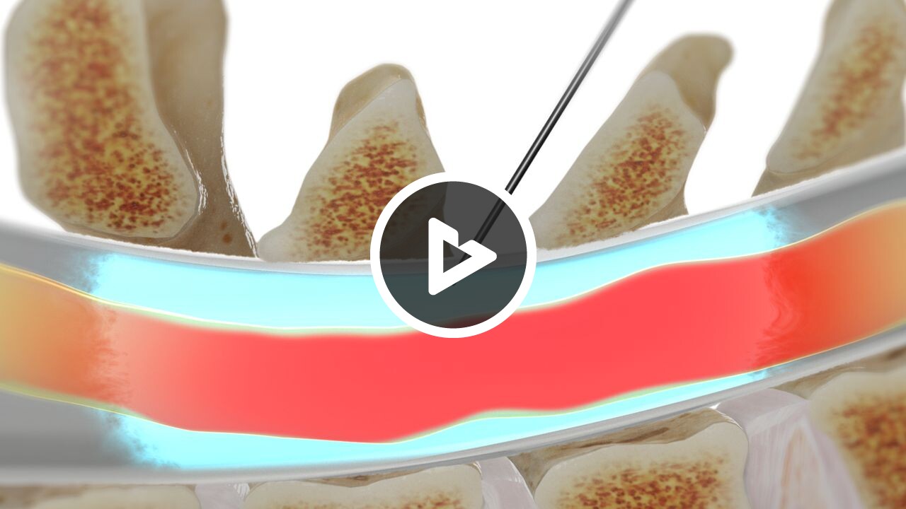 Epidural Steroid Injection (ESI) in the Cervical Spine