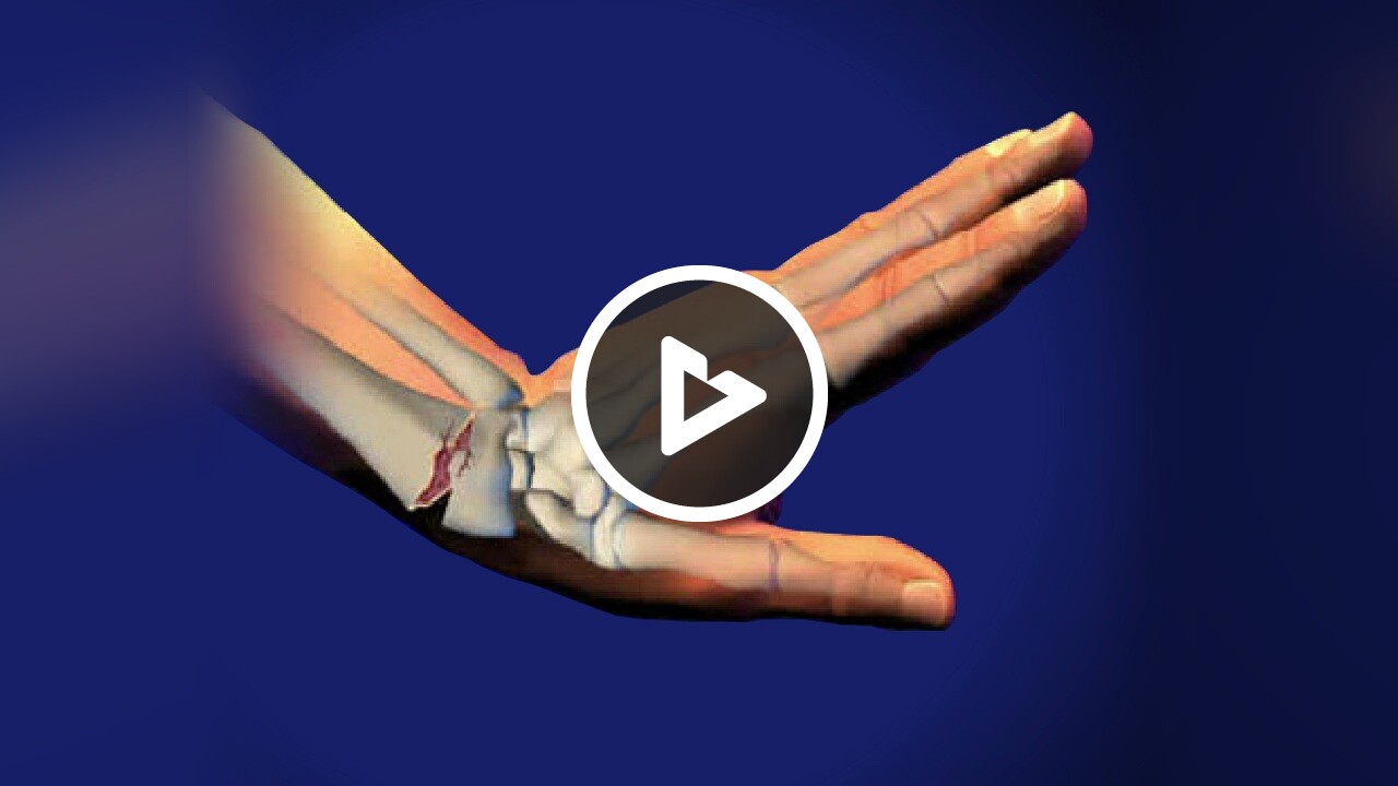 Colles Fractures