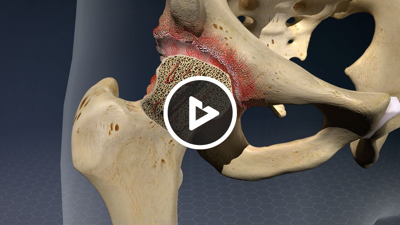 Core Decompression for Avascular Necrosis of the Hip