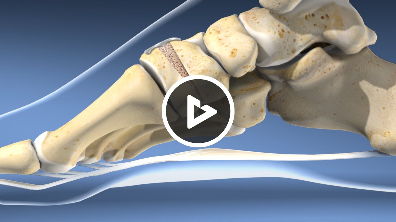 Cotton Osteotomy (Medial Cuneiform Opening Wedge Osteotomy)