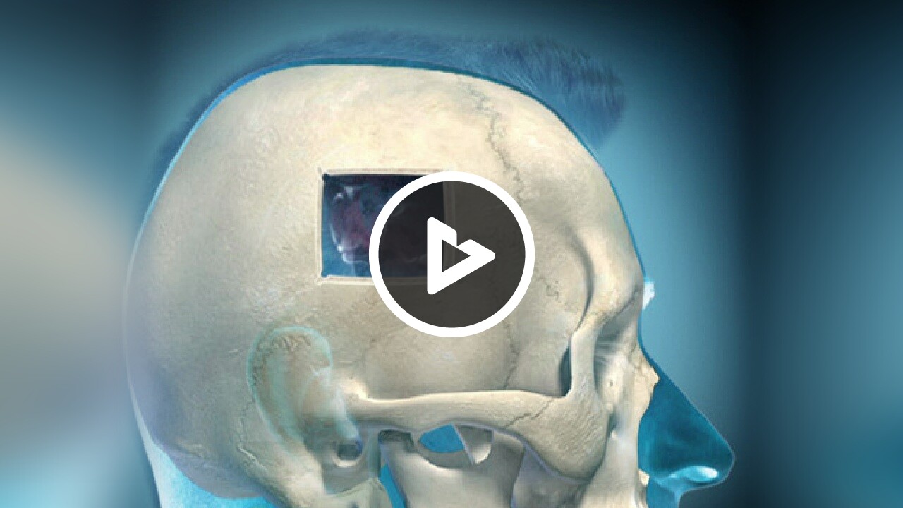 Craniotomy for Subdural Hematoma