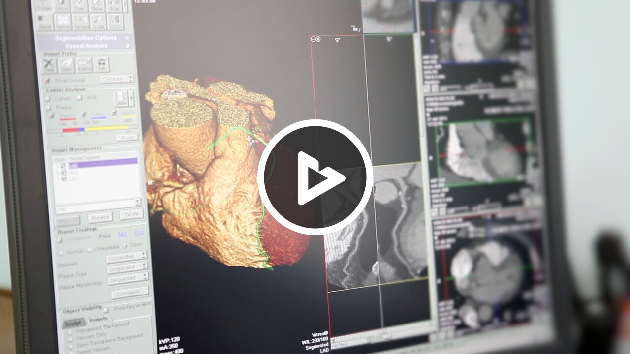 Heart Scan (Coronary Calcium Scan)
