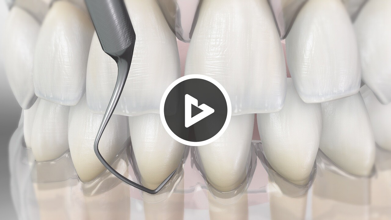 Scaling and Root Planing (Deep Cleaning)