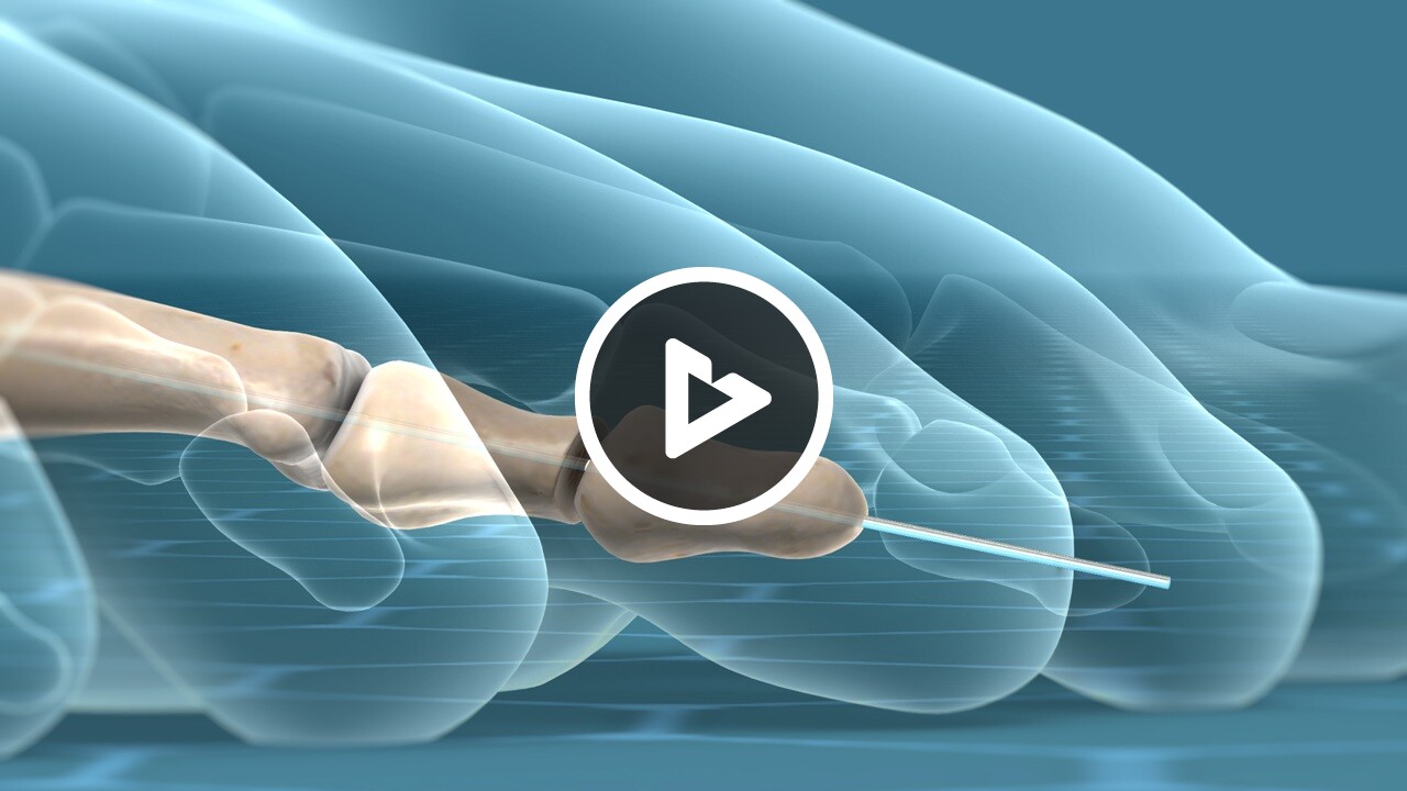 Mallet Toe Correction (DIP Joint Arthroplasty)