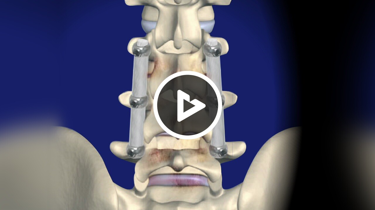 Spine Stabilization System (DYNESYS)