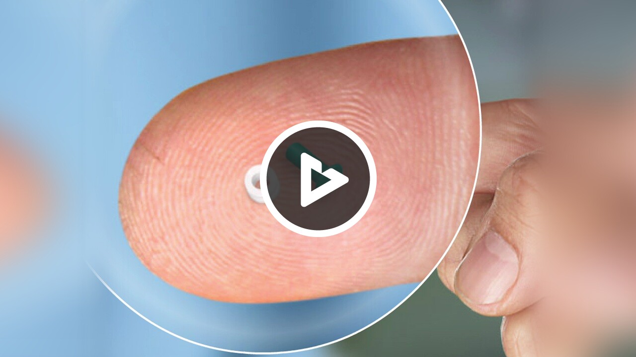 Ear Tube Surgery (Myringotomy)