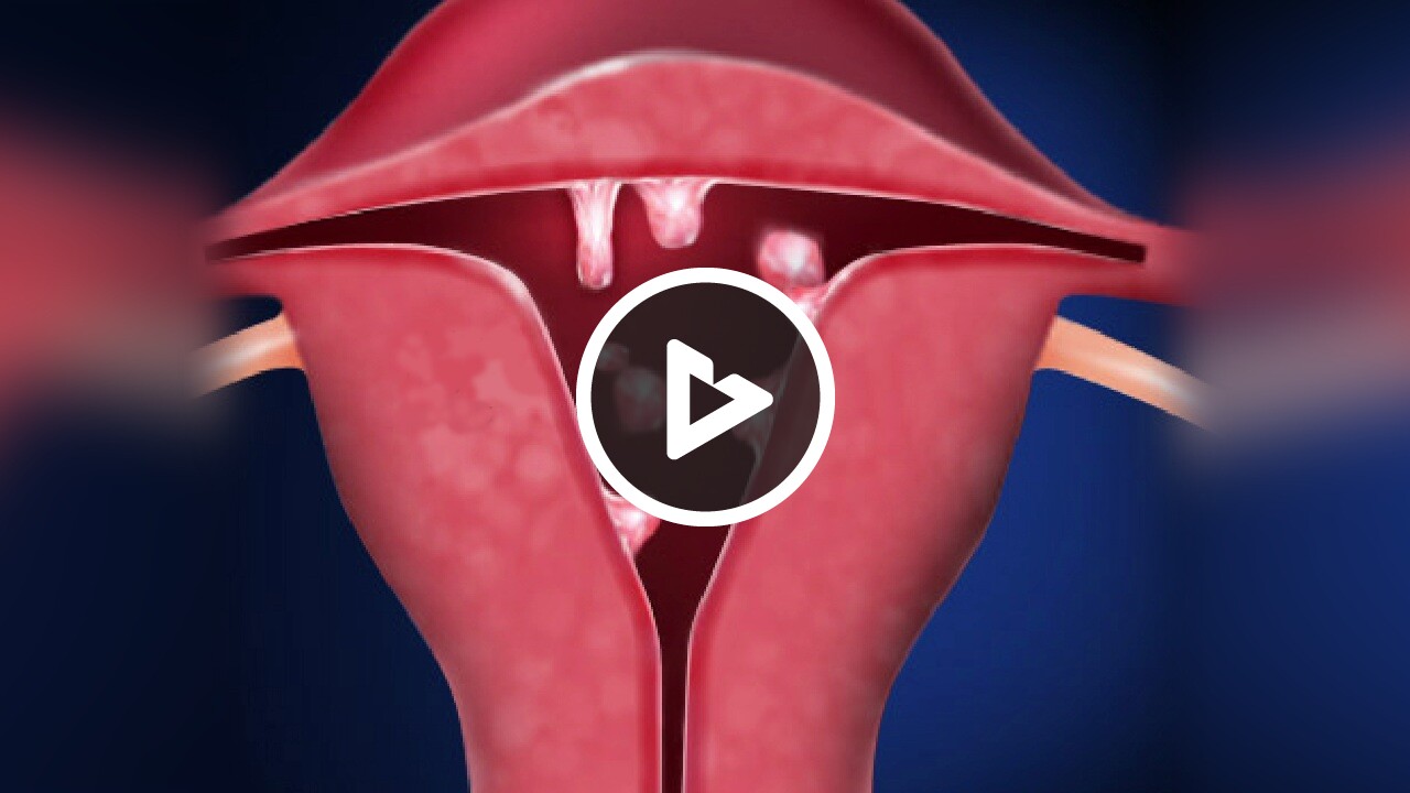 Uterine Polyp (Endometrial Polyp)