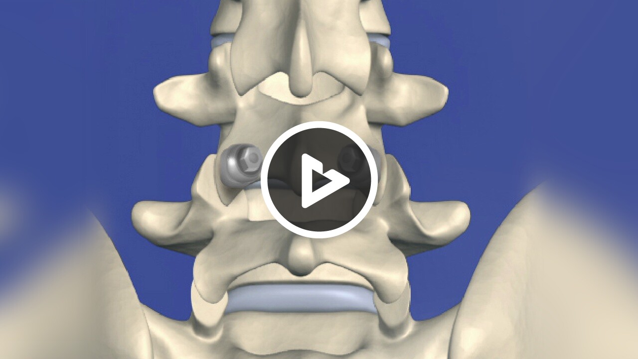 Facet Fixation (US Spine)