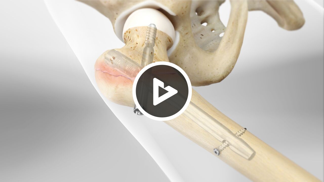 Femur Fracture Fixation (Stryker Gamma Nail)
