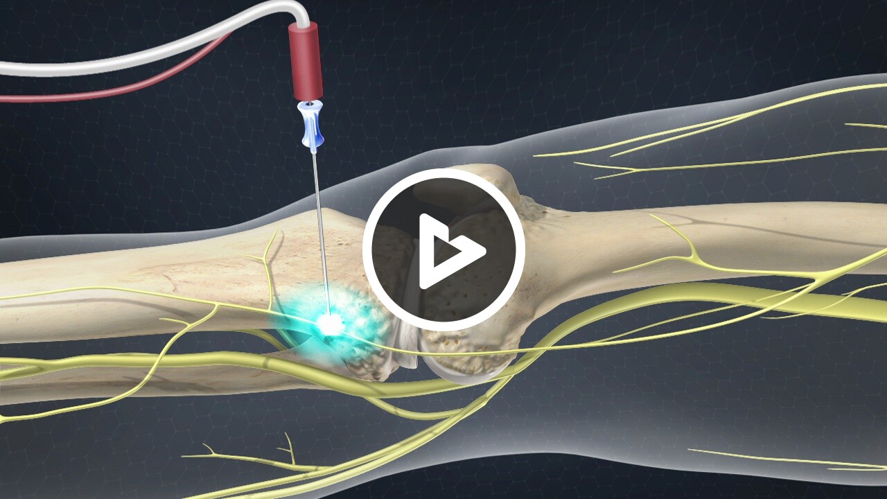Genicular Nerve Ablation (RF Neurotomy)