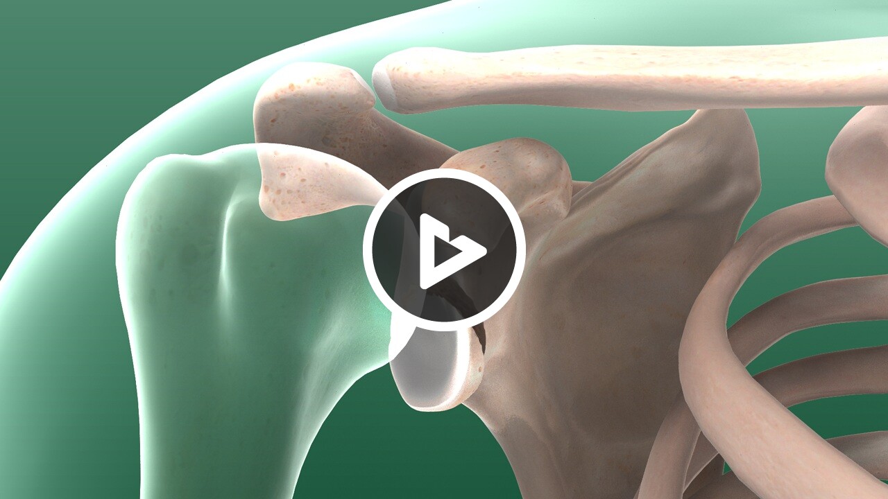 Fracture of the Shoulder Socket (Glenoid Fracture)
