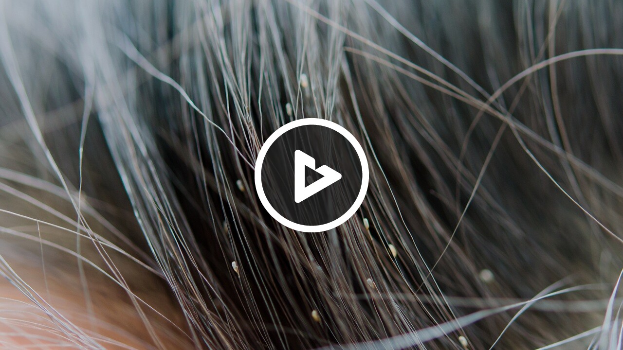 Head Lice
