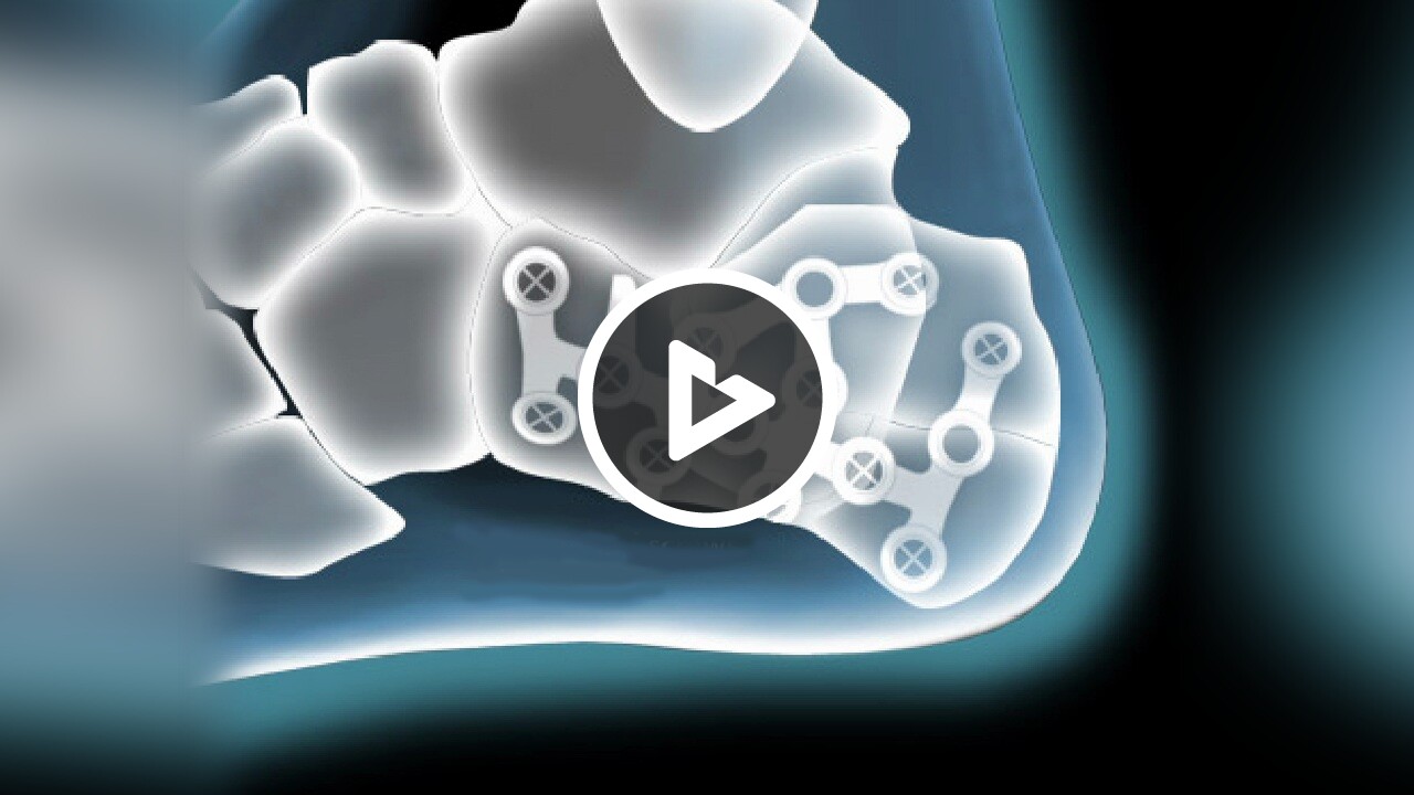 Calcaneal Fracture Fixation (Open Reduction and Internal Fixation)