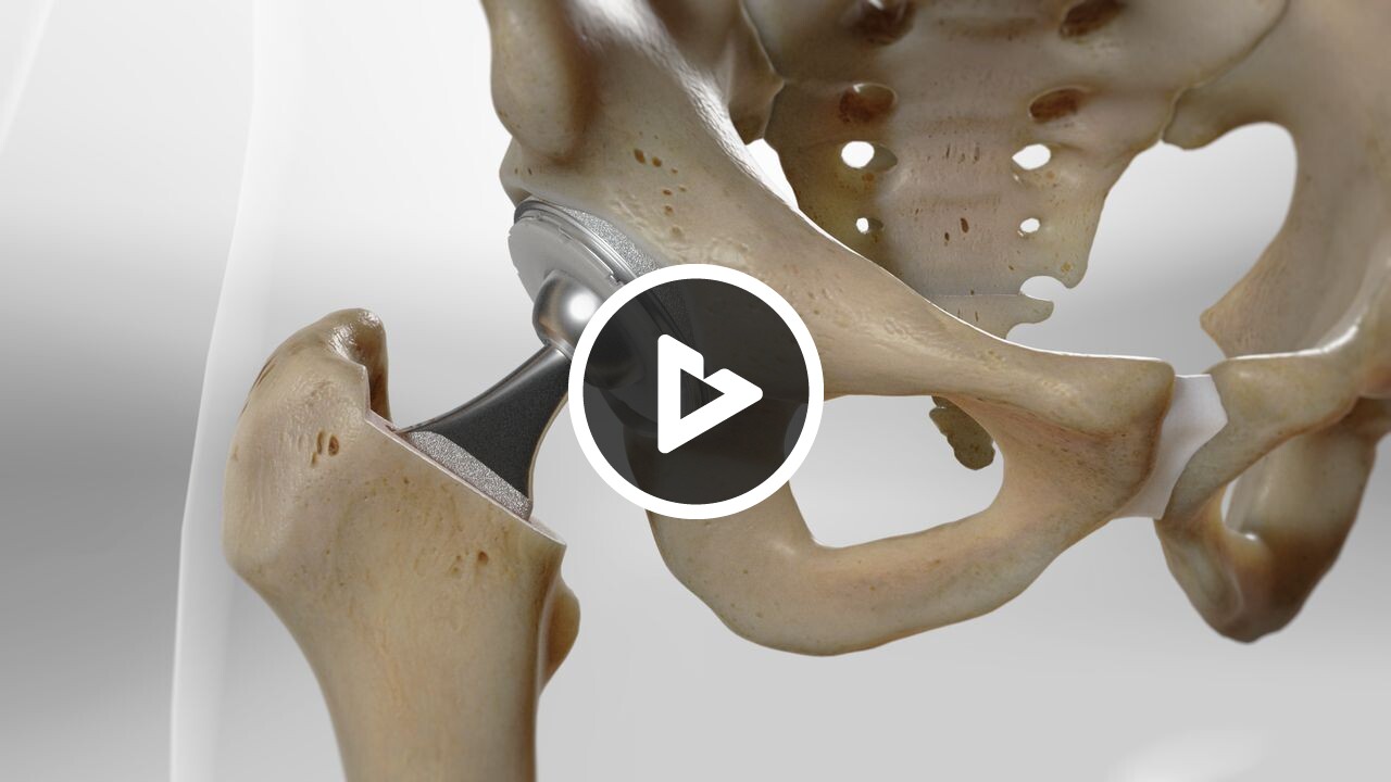 Total Hip Replacement, Anterior Approach (Accolade II)