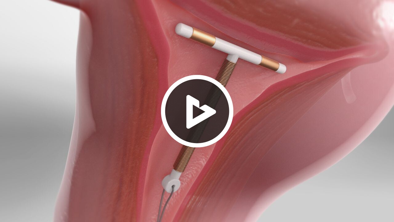 Copper IUD (Intrauterine Device)