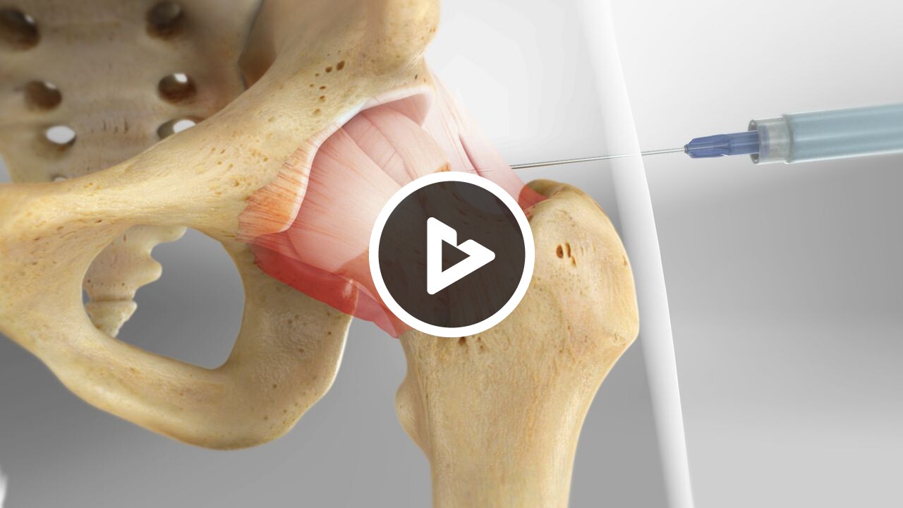 Hip Joint Injection