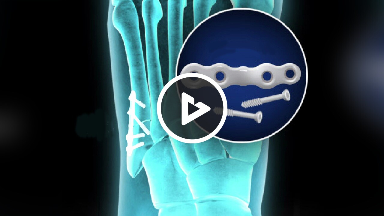 Jones Fracture Fixation (Intramedullary Screw)