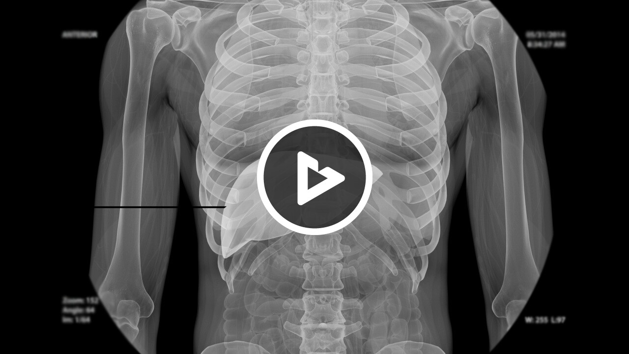 Liver Biopsy (Percutaneous)