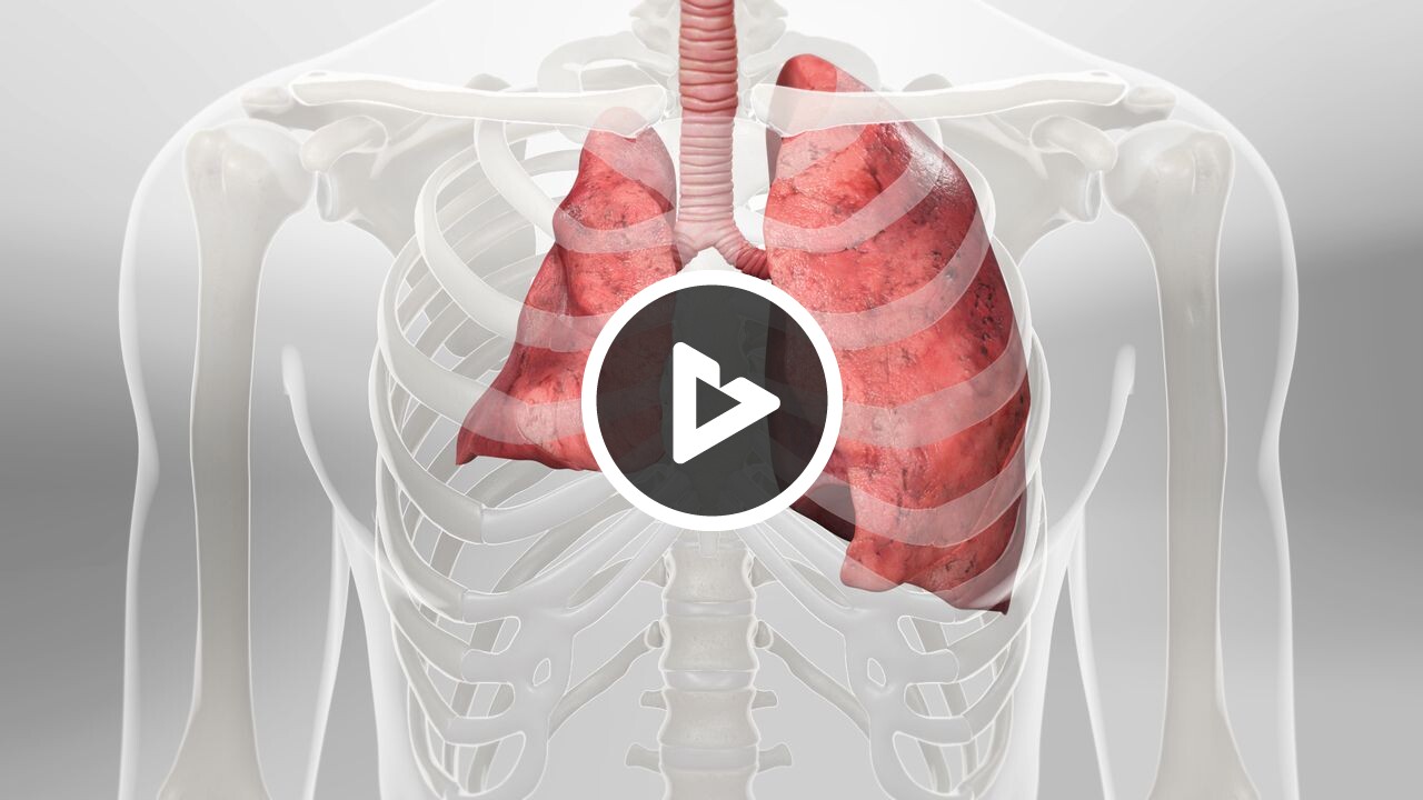 Collapsed Lung (Atelectasis)