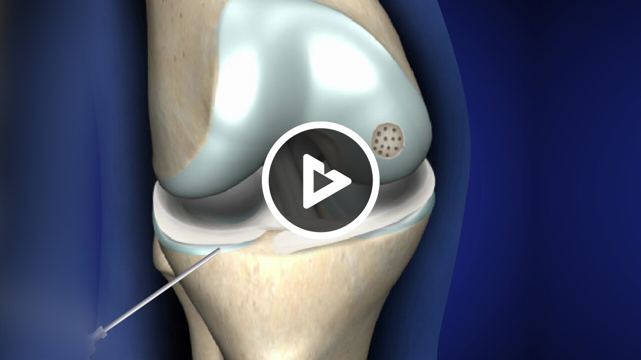 Microfracture Drilling Procedure for Isolated Chondral Defect