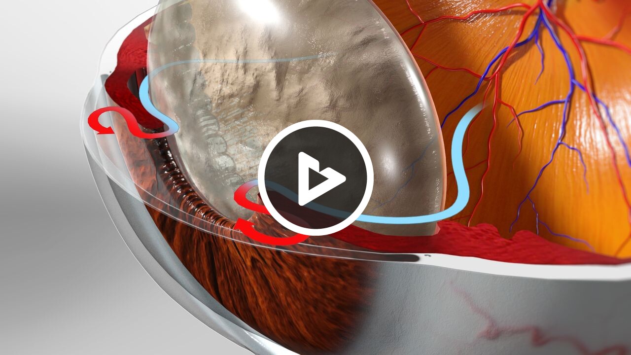 Glaucoma (Angle Closure Type)