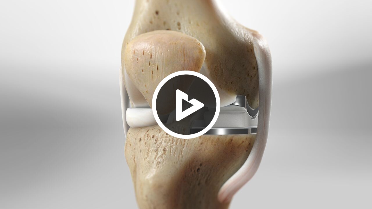 Partial Knee Replacement