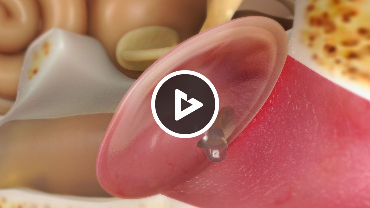 Ruptured Eardrum (Perforated Eardrum)