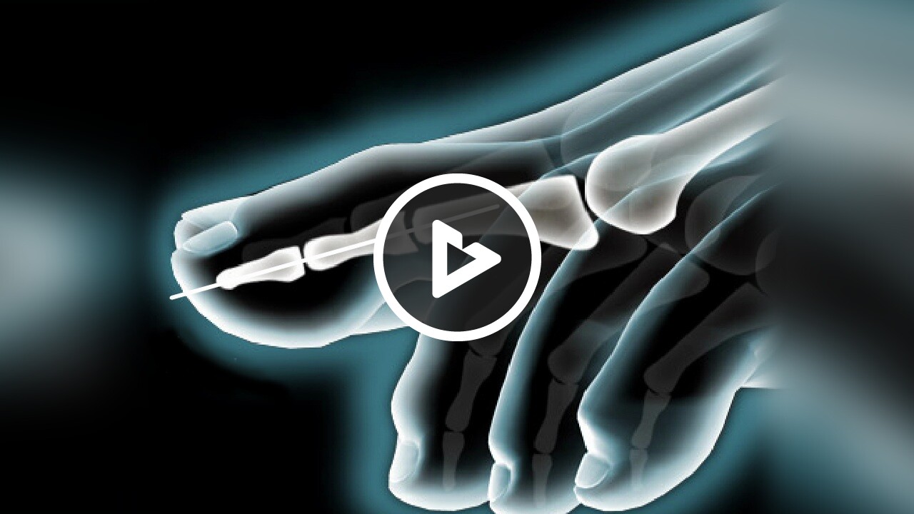 Hammertoe Correction (PIP Joint Arthroplasty)