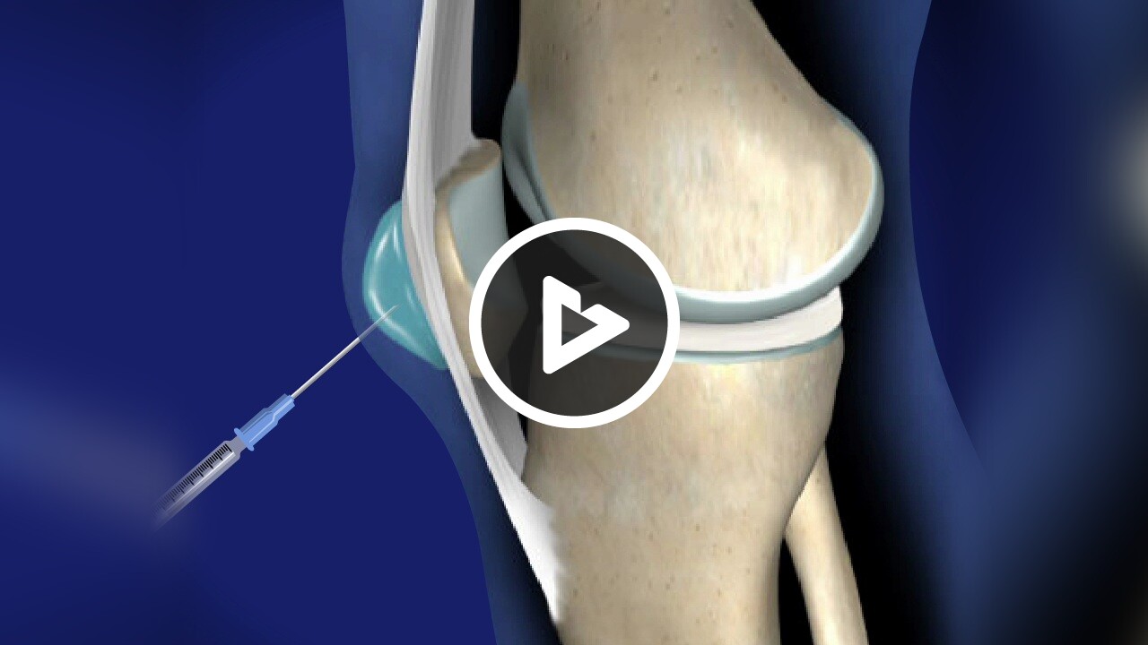 Aspiration of the Prepatellar Bursa