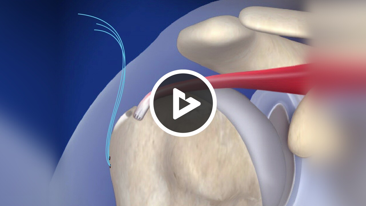 Rotator Cuff Repair (Mini-Open, Supraspinatus Tendon-to-Bone Insertion)