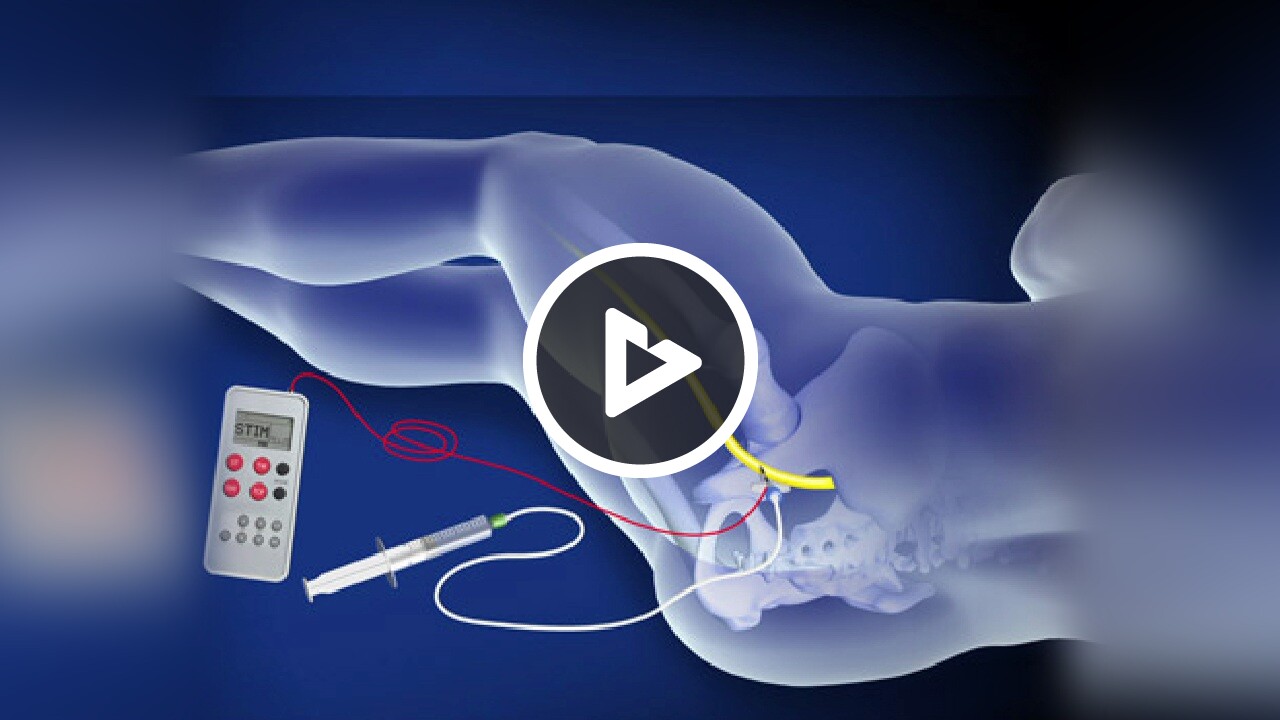 Sciatic Nerve Block (Posterior Approach, Electric Stimulation)