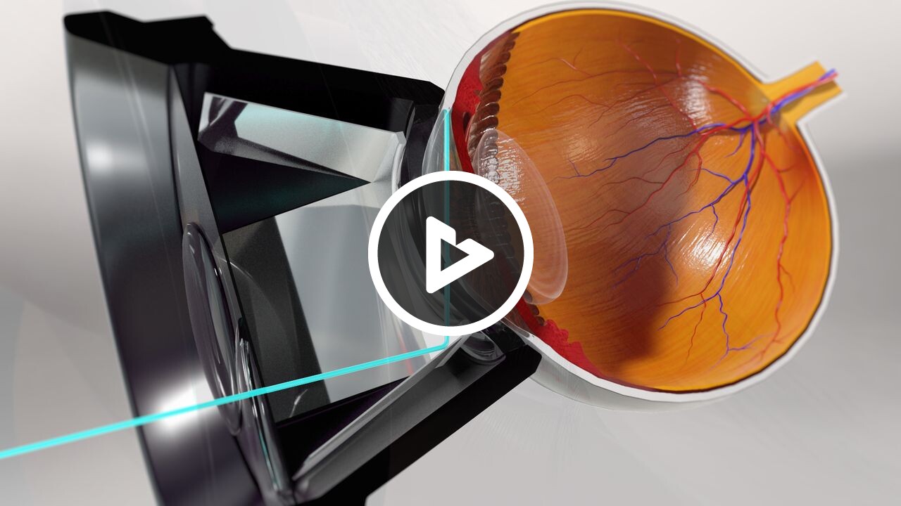 Selective Laser Trabeculoplasty (SLT)