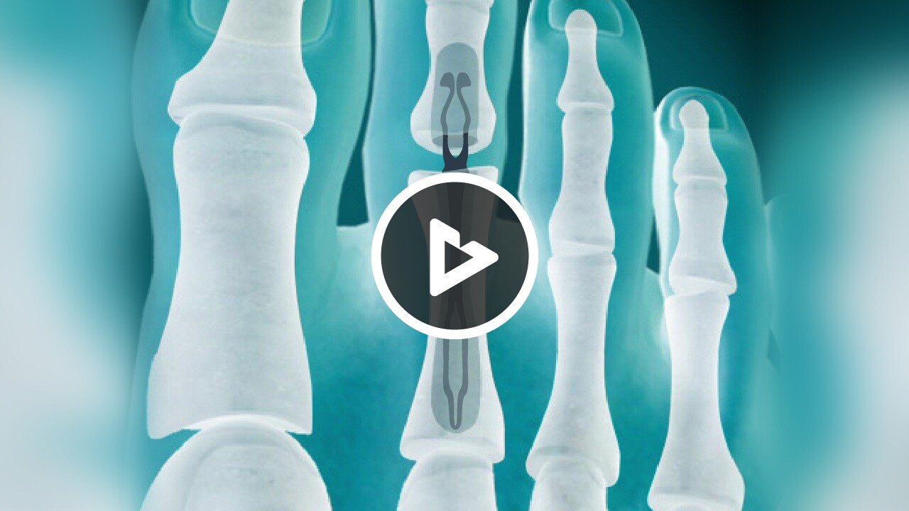 SMART Toe Intramedullary Memory Implant