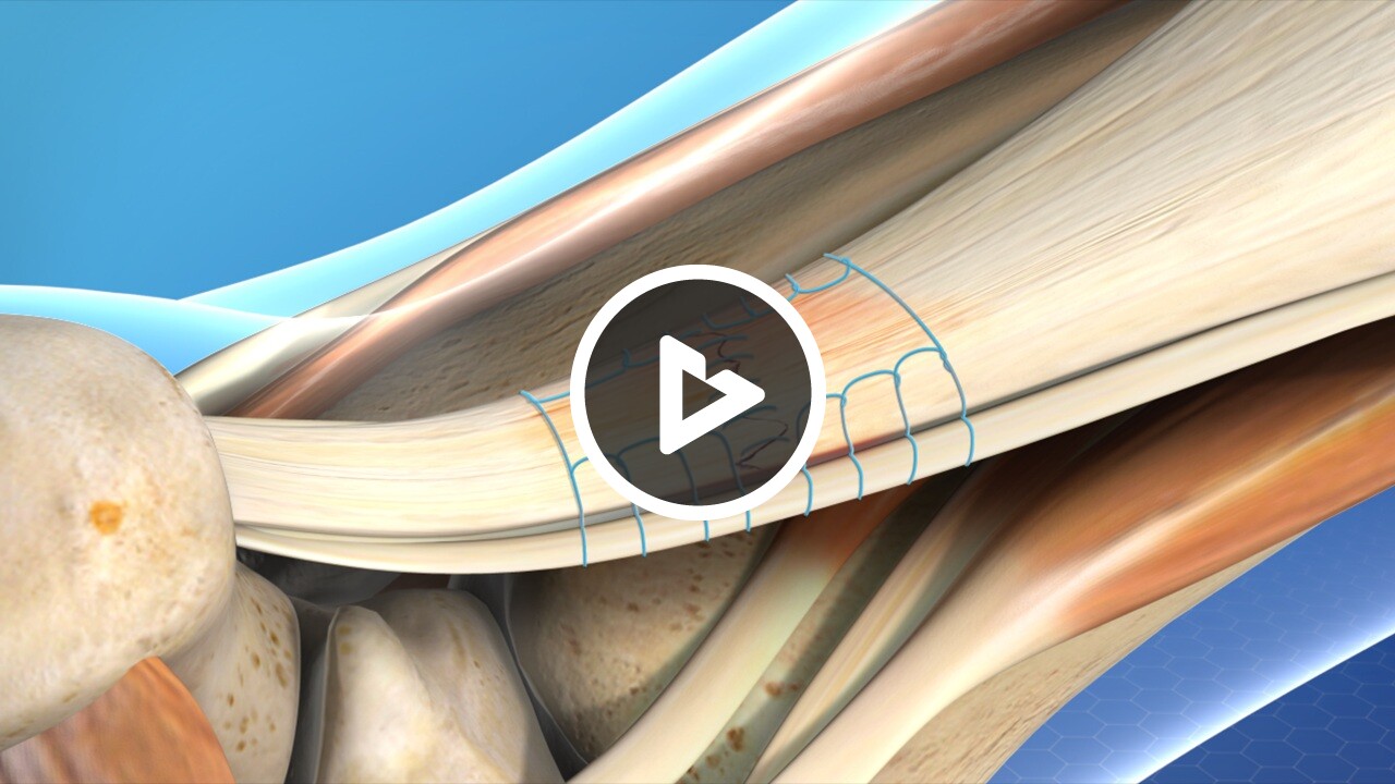 Tendon Repair (Augmentation with Collagen Graft)