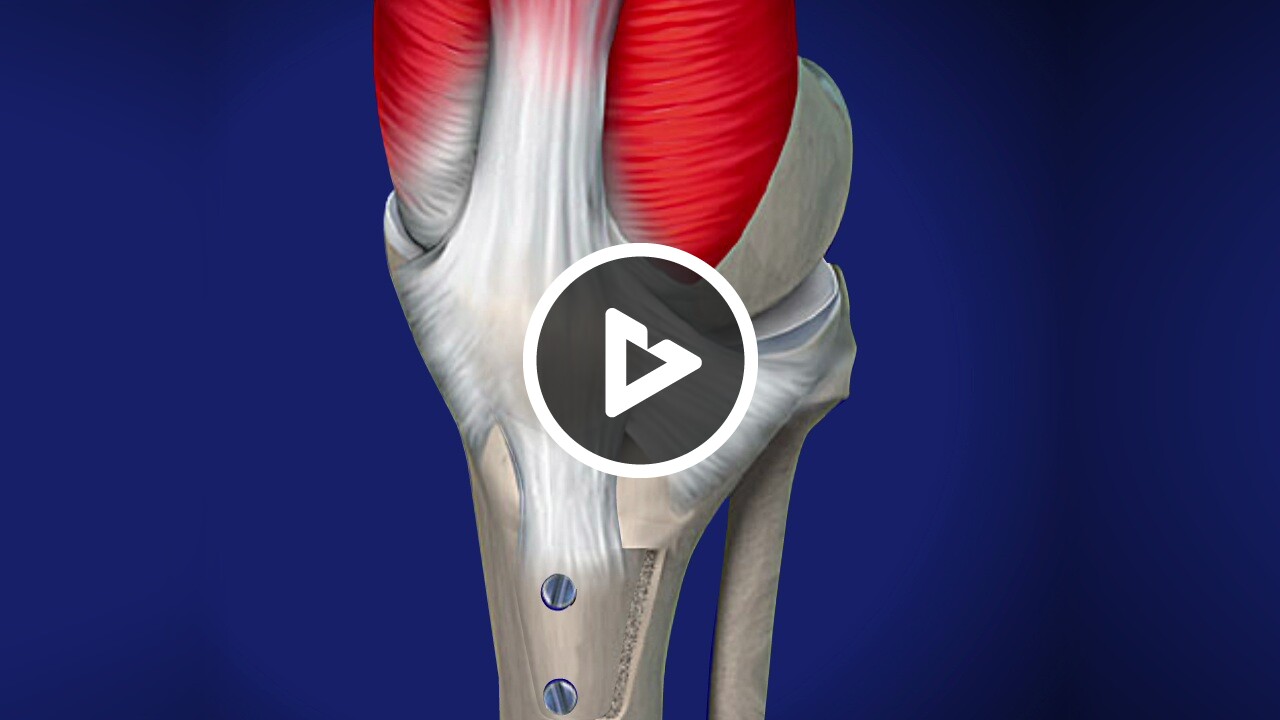 Tibial Tubercle Osteotomy (TTO)
