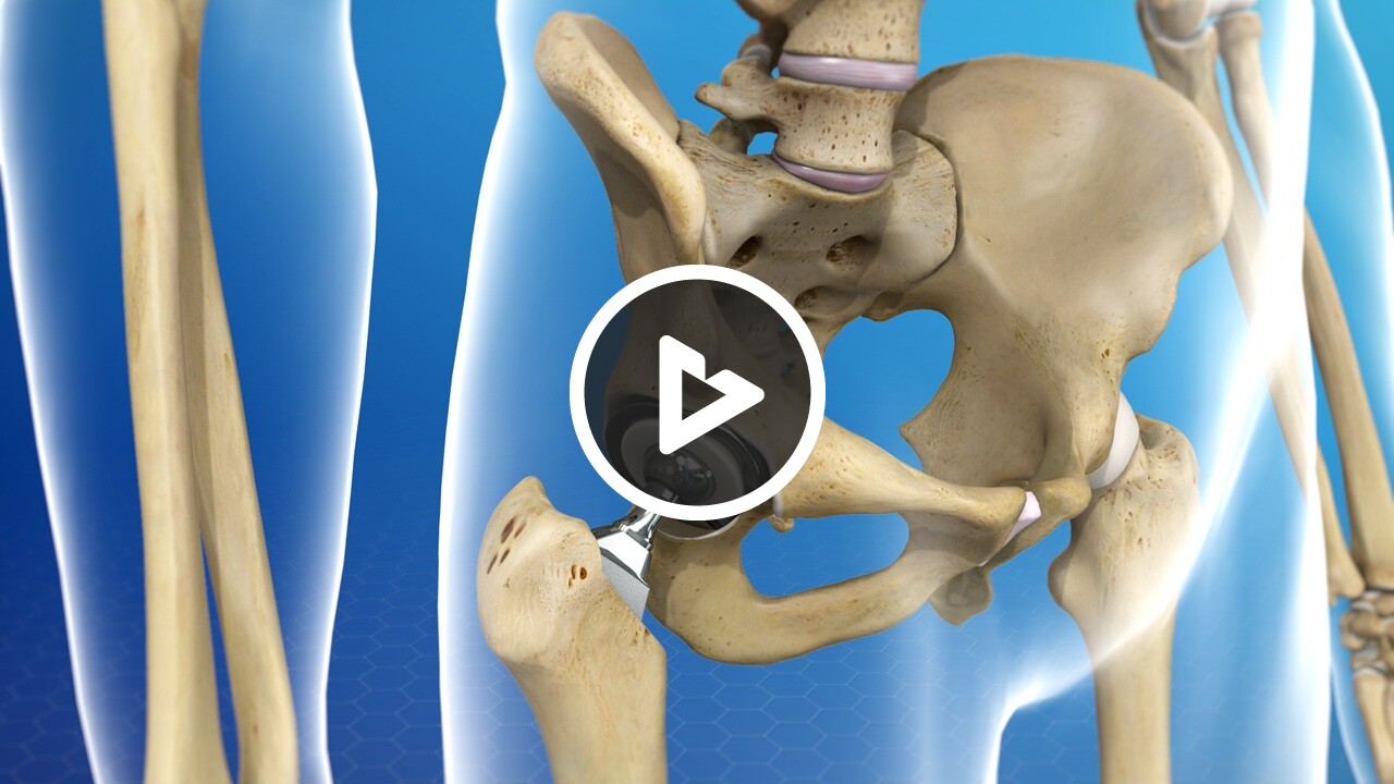 Total Hip Replacement (Metal on Metal with Liner)