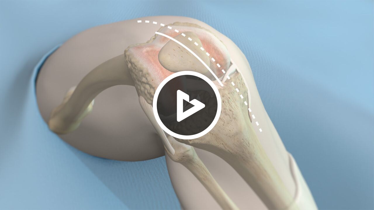 Total Knee Replacement (Mini-Incision Method)