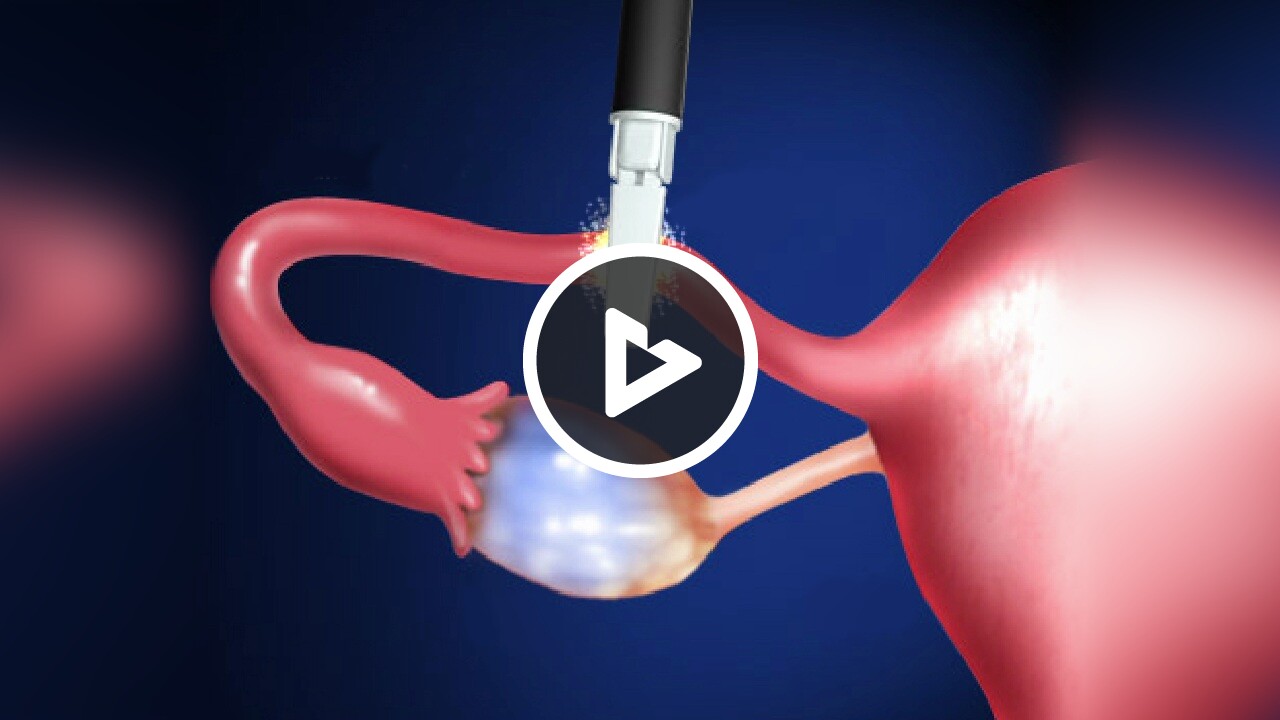 Tubal Ligation (Laparoscopic Coagulation Method)