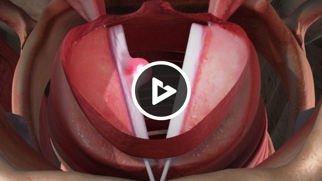 Vocal Cord Polyp
