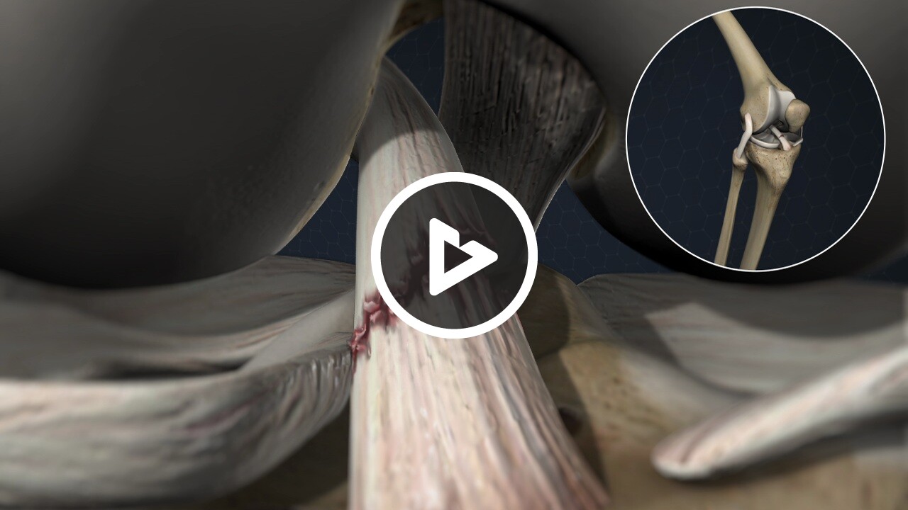 Anterior Cruciate Ligament (ACL) Injuries in Women